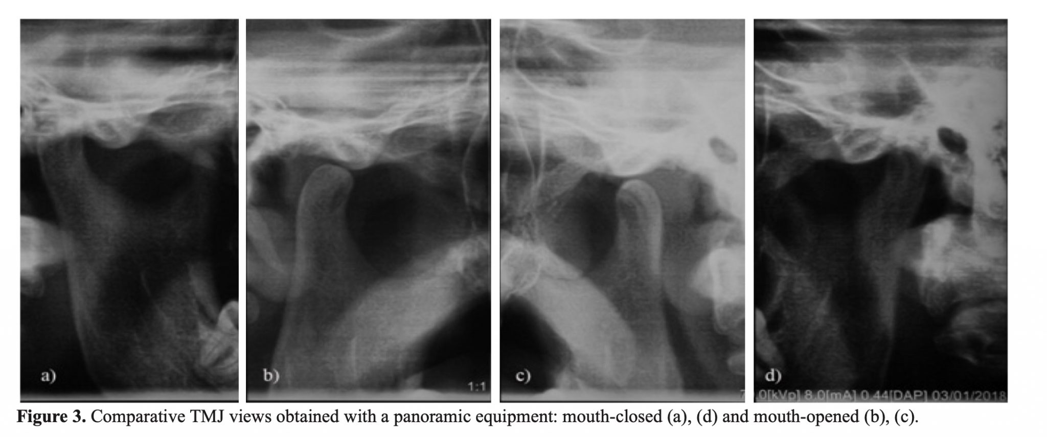 Temporomandibular joints, Temporomandibular Joint Disorders, and ...