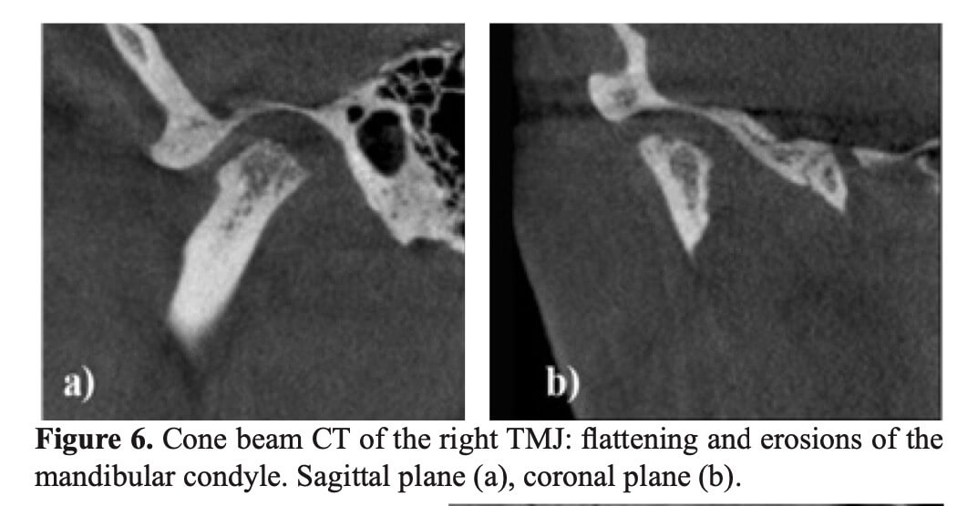Temporomandibular joints, Temporomandibular Joint Disorders, and ...